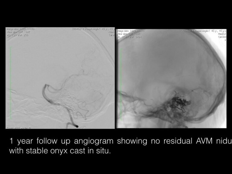 Cure of Cerebellar AVM by Endovascular Embolisation