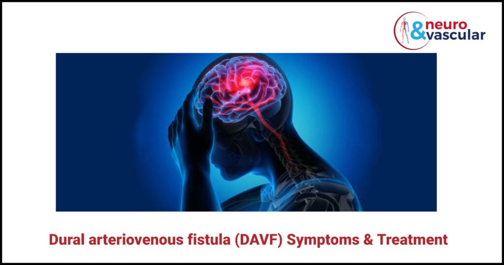Dural arteriovenous fistula (DAVF) Symptoms and Treatment