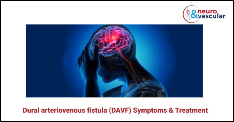 Dural arteriovenous fistula (DAVF) Symptoms and Treatment