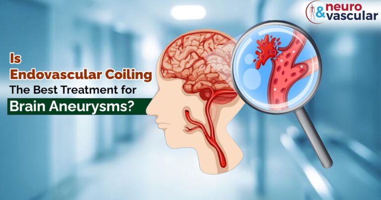 Endovascular Coiling Procedure for Brain Aneurysms