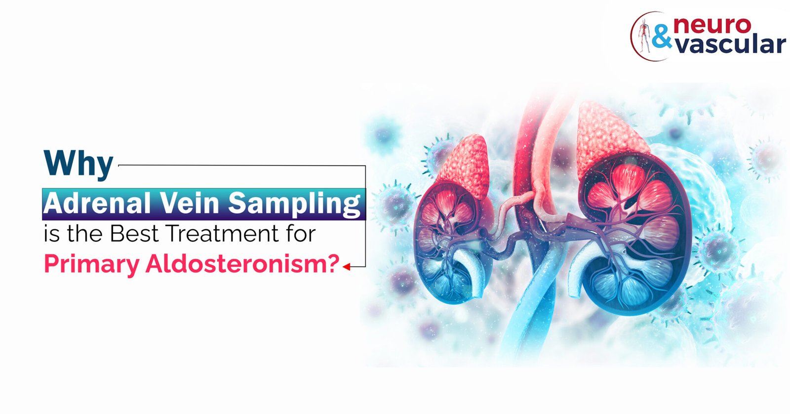 Adrenal Vein Sampling is the Best Treatment for Primary Aldosteronism