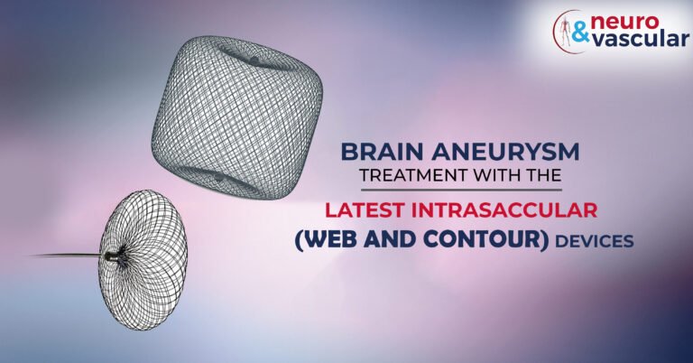 Brain Aneurysm Treatment with Intrasaccular (Web and Contour) Devices