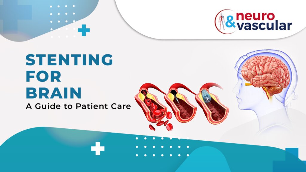 Stenting for Brain: A Guide to Patient Care
