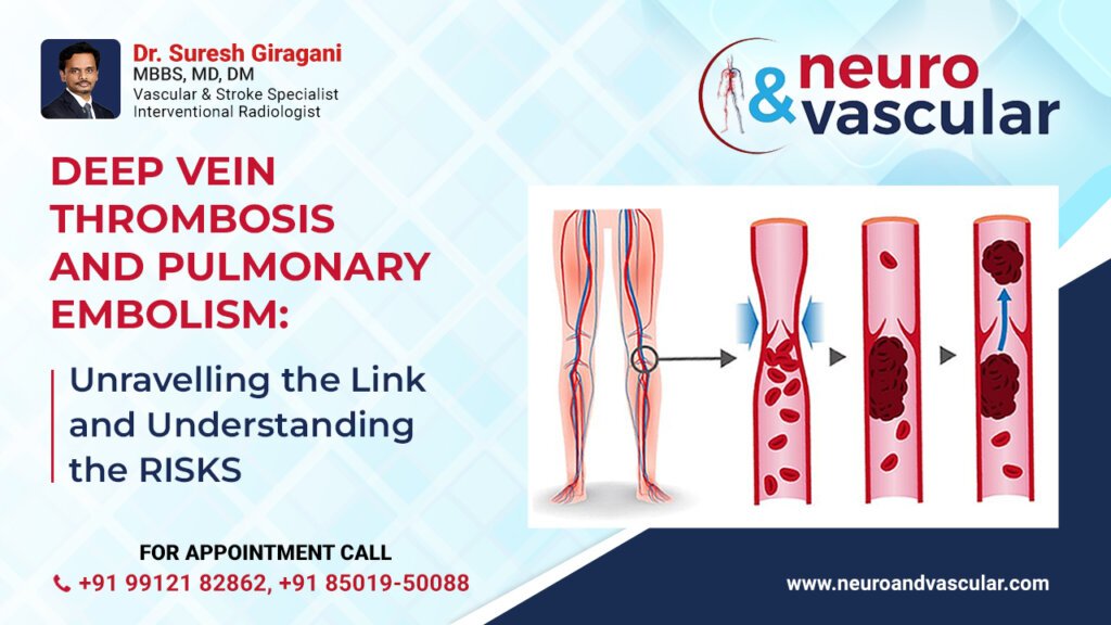 Deep Vein Thrombosis and Pulmonary Embolism