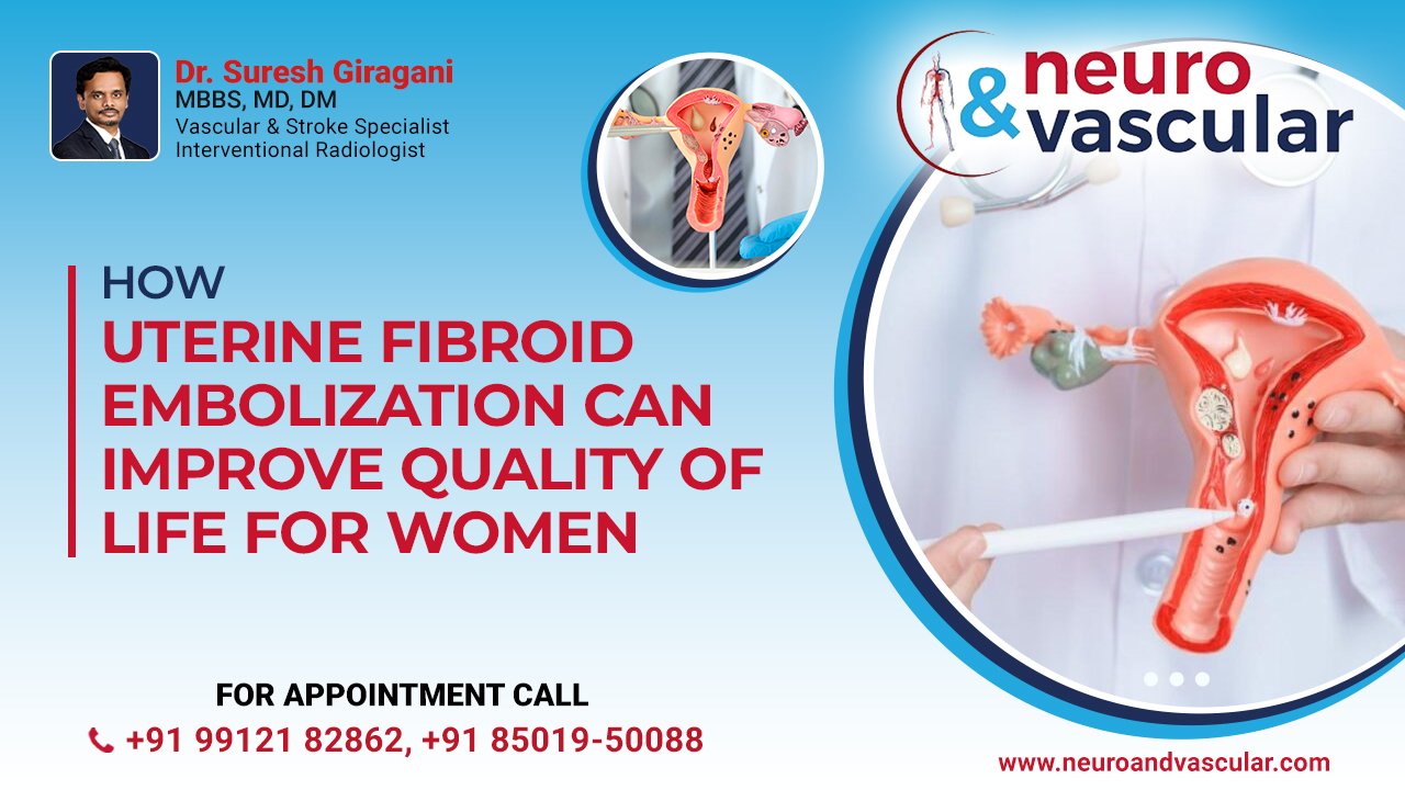 How Uterine Fibroid Embolization Can Improve Quality