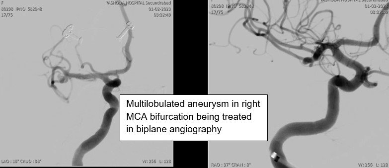 Applications of Bi-plane Angiography | DR. Suresh Giragani