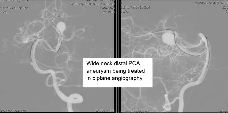 Applications of Bi-plane Angiography | DR. Suresh Giragani